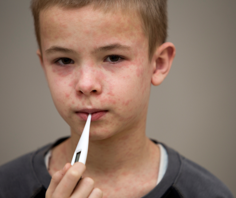 Rujeola (pojar) – cum se transmite, ce simptome are, diagnostic ...